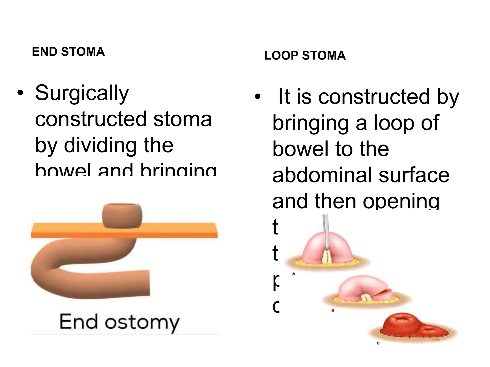 ostomy-care.pptx