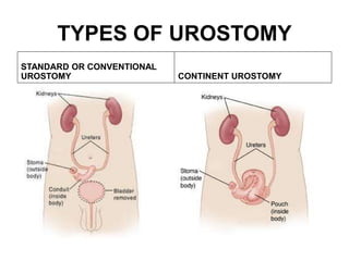 ostomy-care.pptx