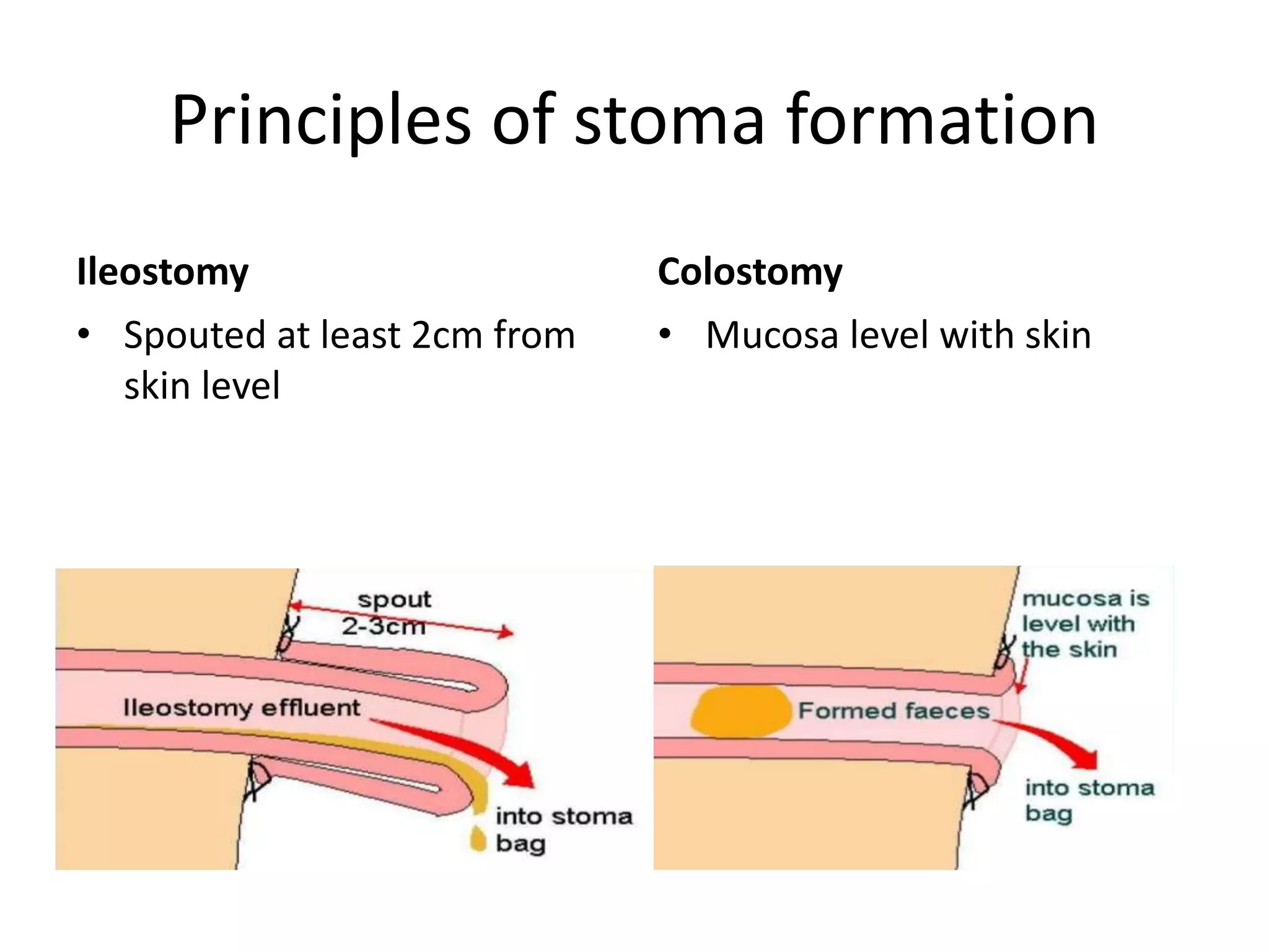 Ostomy surgery | PPTX