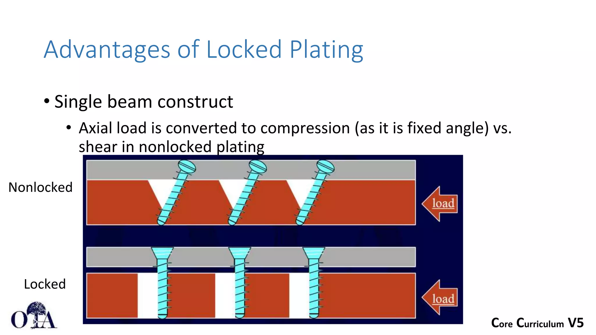 Locking Plates in Orthopaedic | PPTX