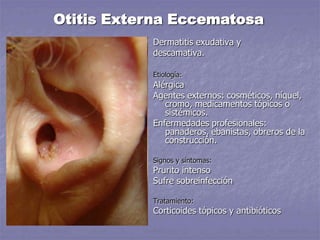 Otalgia | PPT