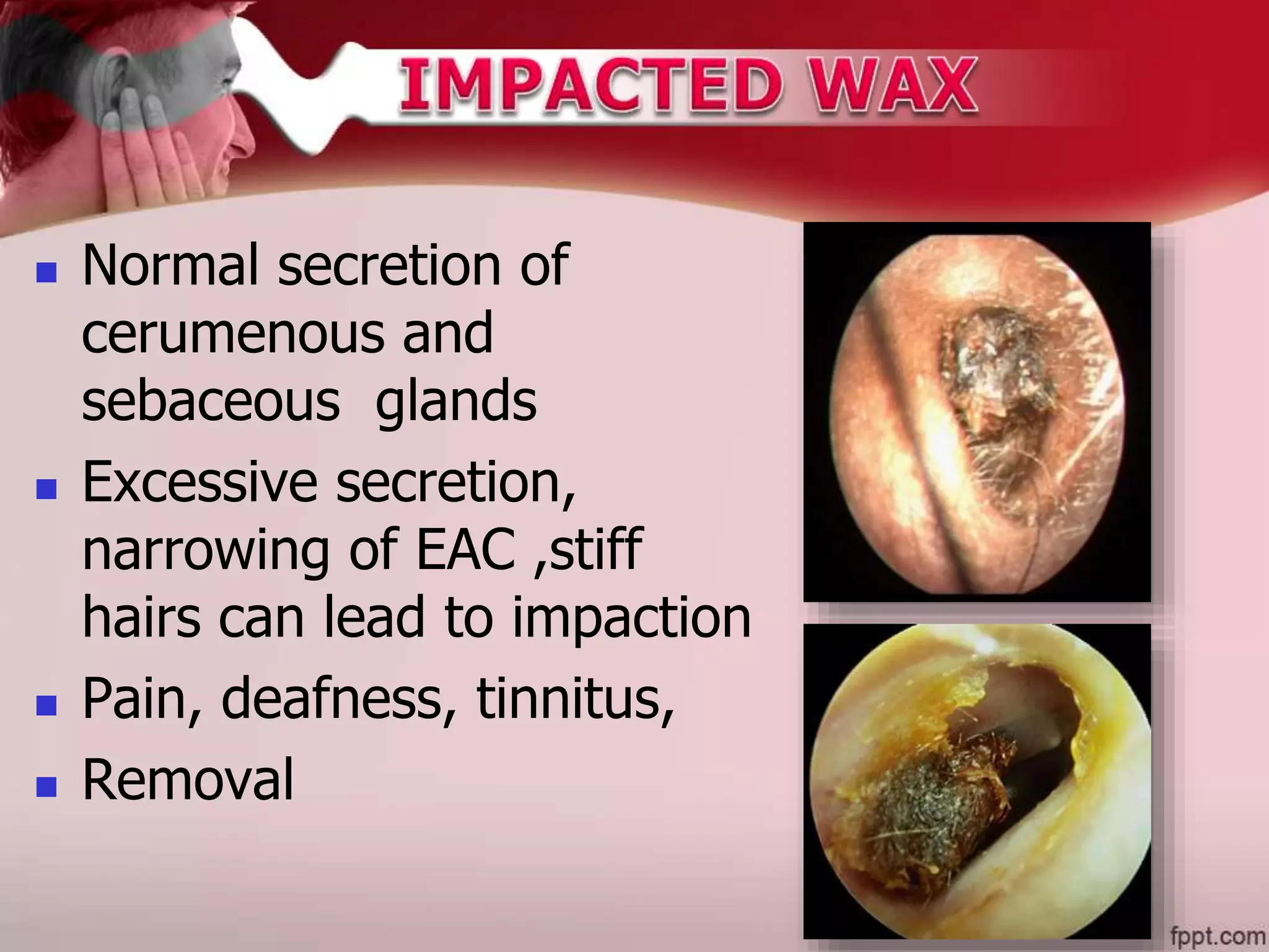 Otalgia/earache | PPTX