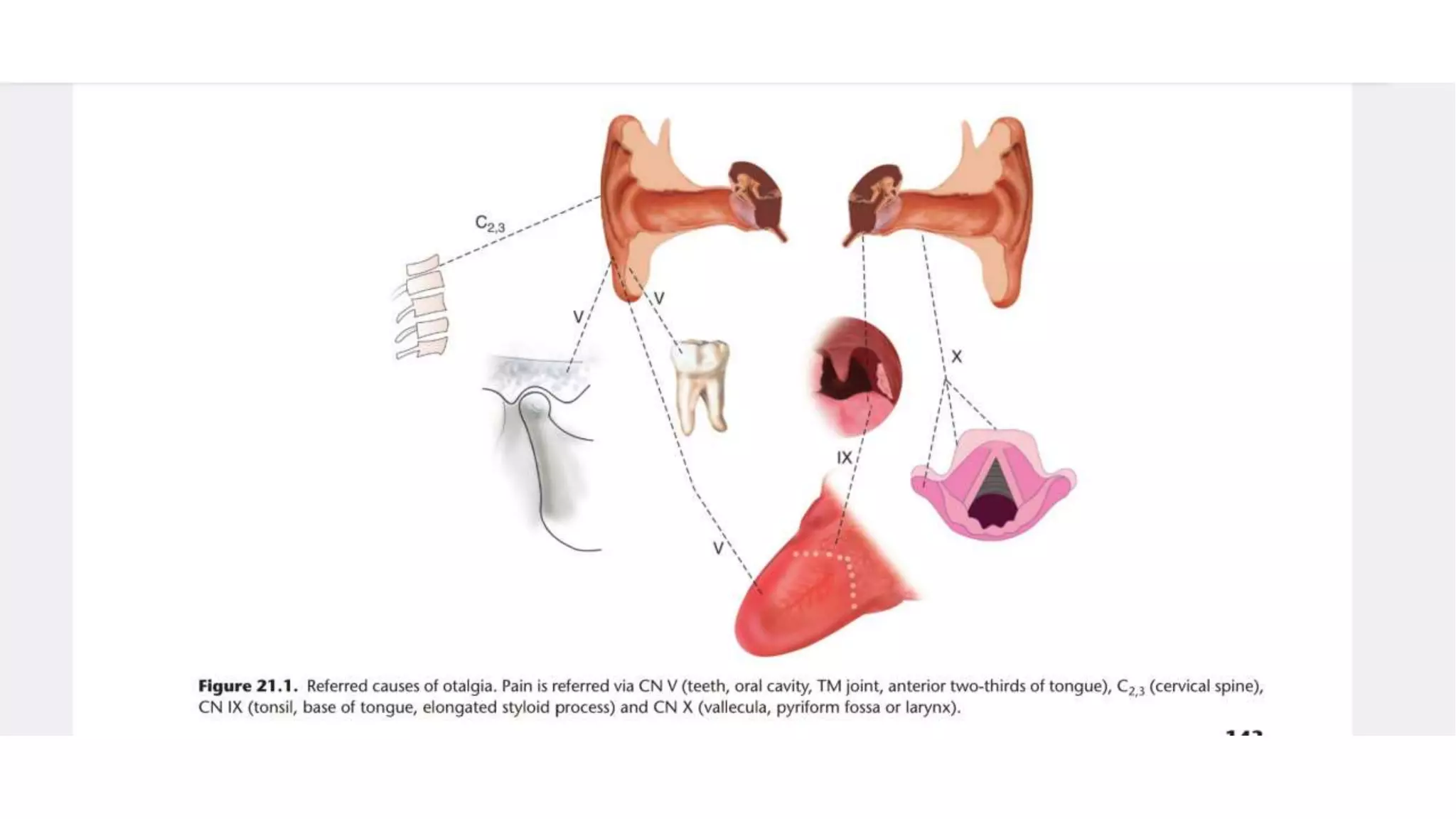 Otalgia | Ear pain | Earache | Complete lecture | कर्णशूल | #ent | PPTX