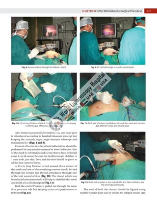 Other Minimal Access Surgical Procedures | PDF