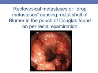 Other clinical features of gastric carcinoma | PPT | Digestive ...