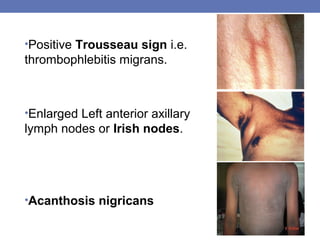 Other clinical features of gastric carcinoma | PPT | Digestive ...