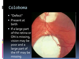 Other eye diseases | PPT