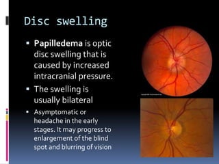 Other eye diseases | PPT