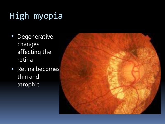 Degenerative myopia retina - halobasta