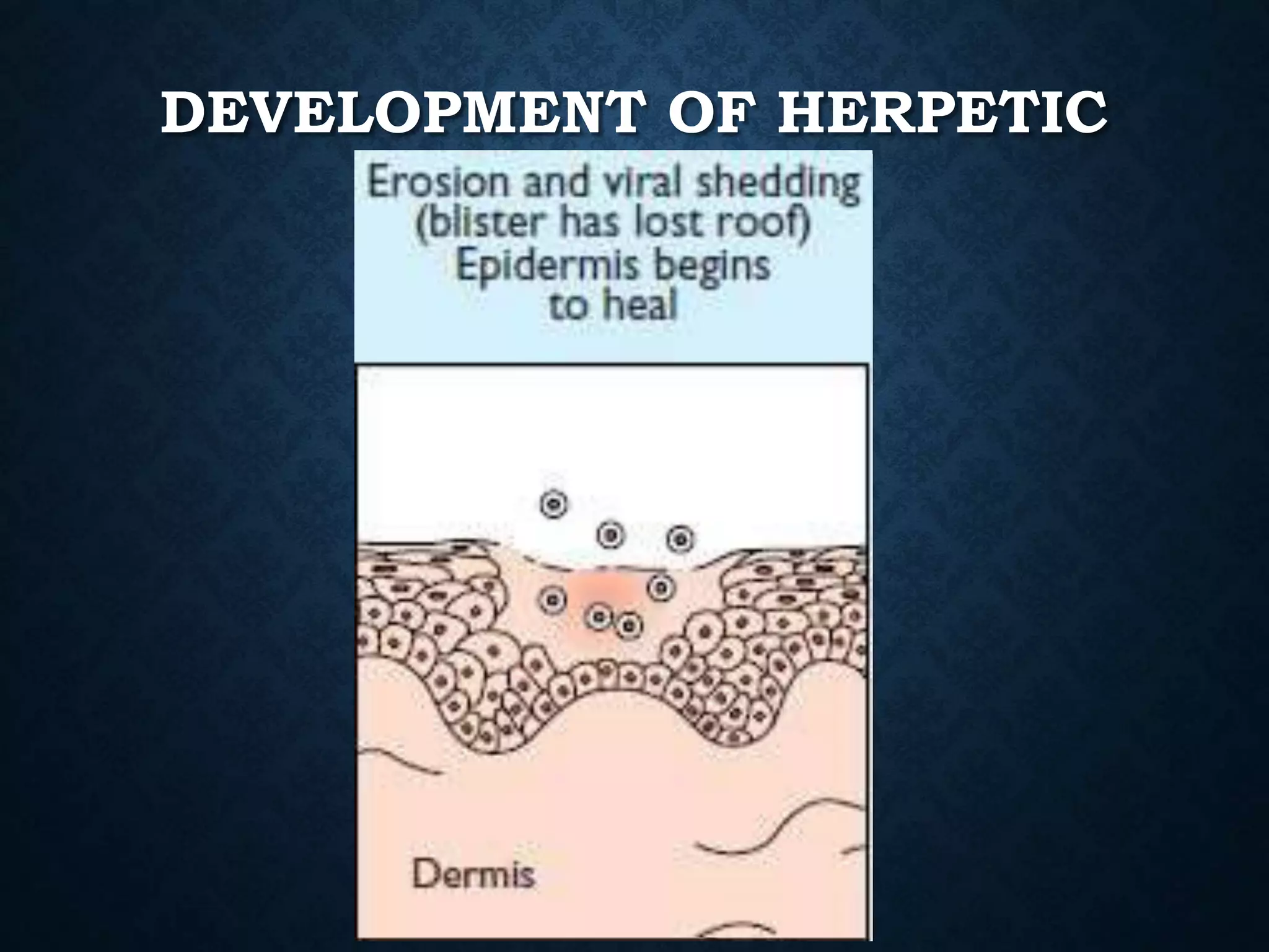 Stds Genital Ulcer Ppt