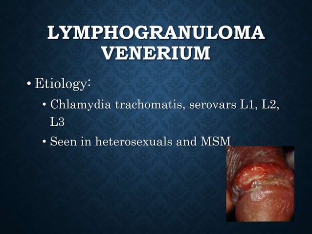 STD’S – GENITAL ULCER