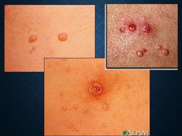 STD’S – GENITAL ULCER