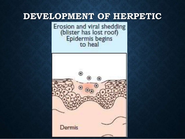 Stds Genital Ulcer