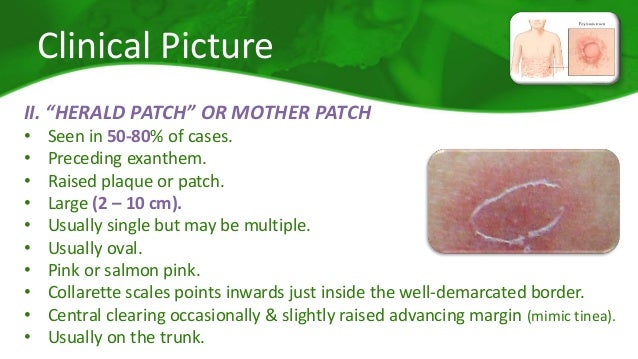 Other papulosquamous disorders