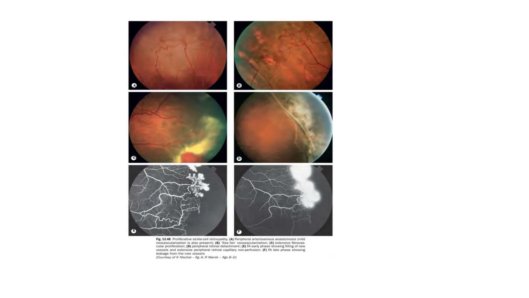 Other Retinal Vascular Diseases.pptx