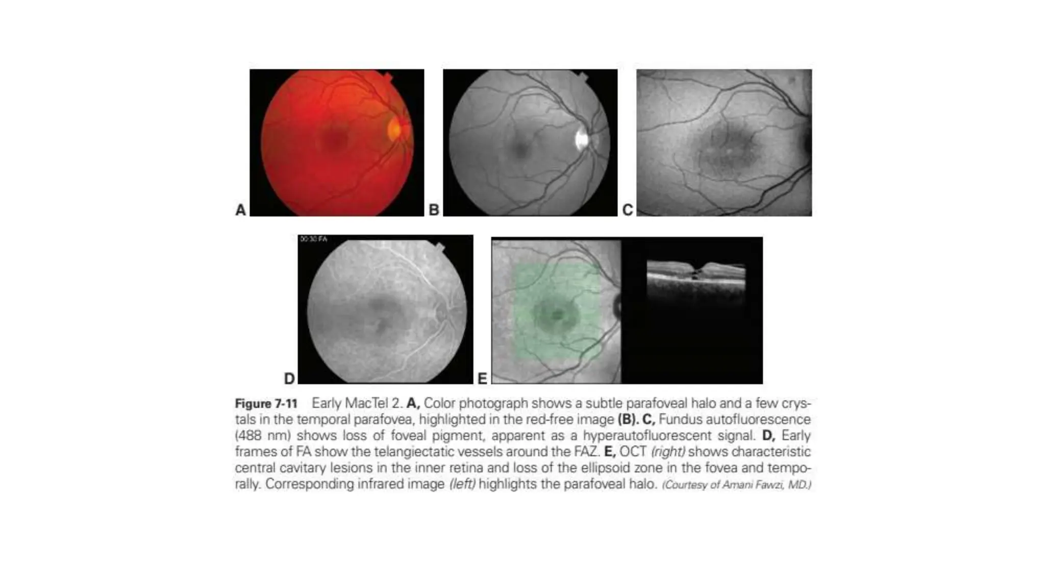 Other Retinal Vascular Diseases.pptx