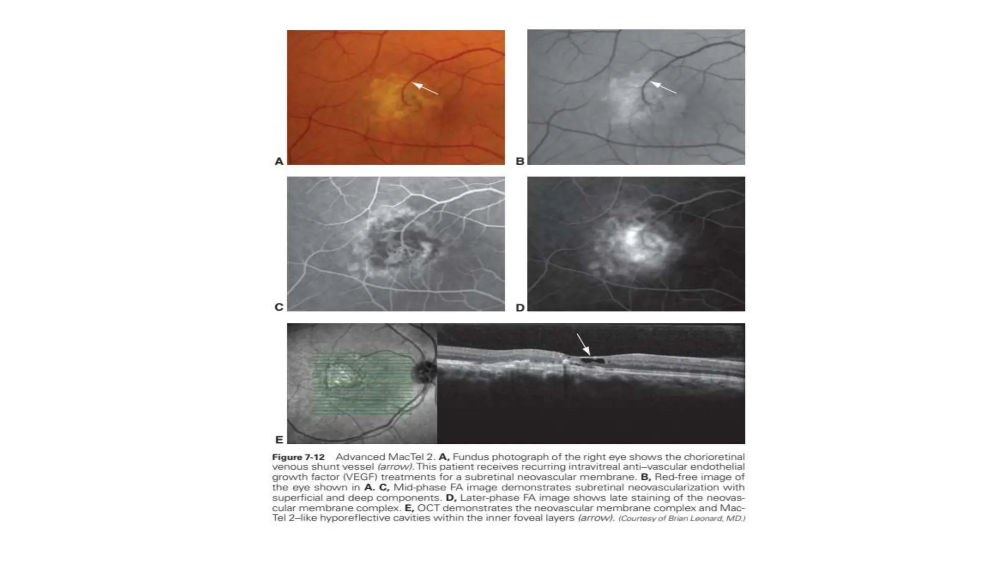 Other Retinal Vascular Diseases.pptx