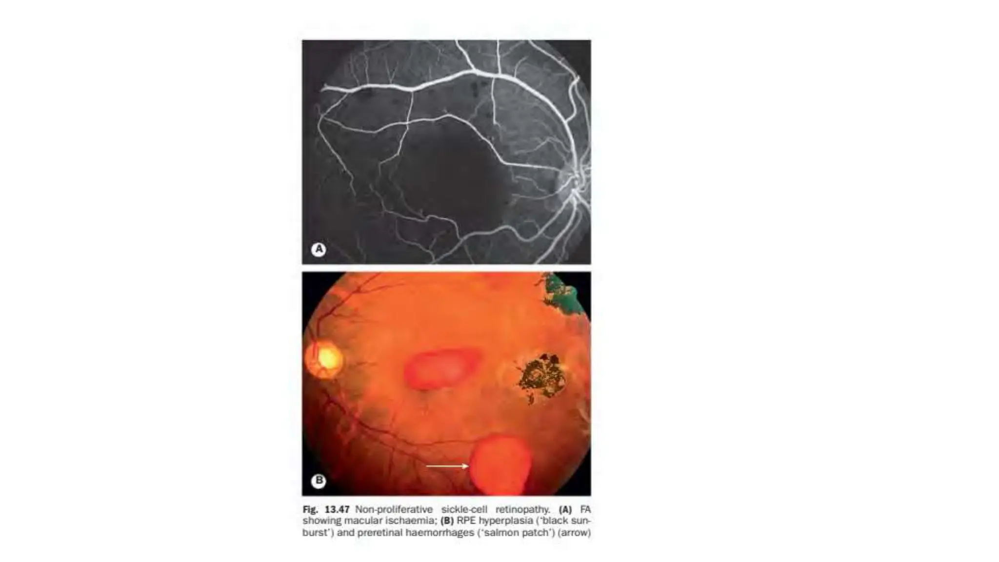 Other Retinal Vascular Diseases.pptx