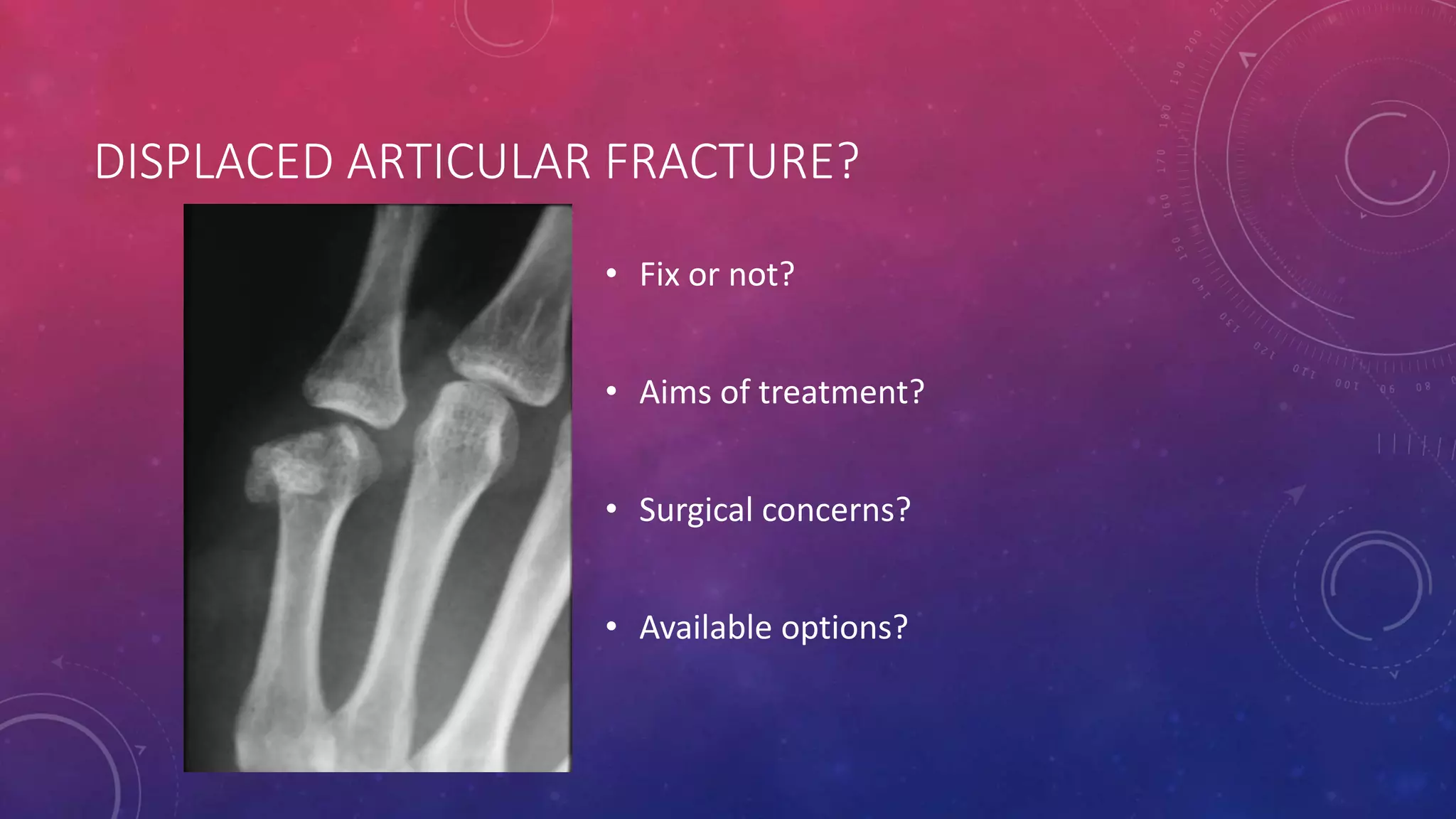 Other techniques in hand fracture treatment | PPTX