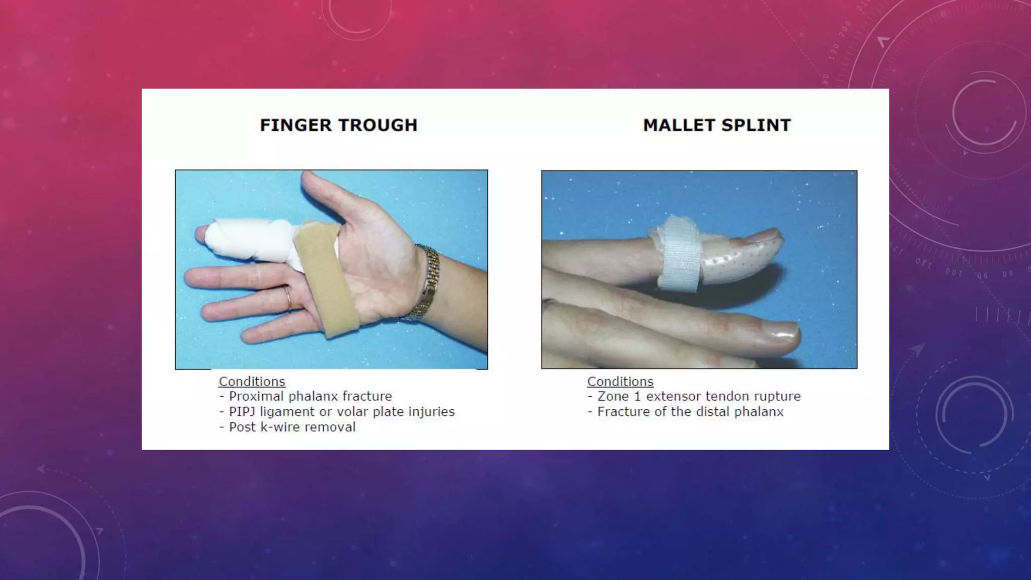 Other techniques in hand fracture treatment | PPTX