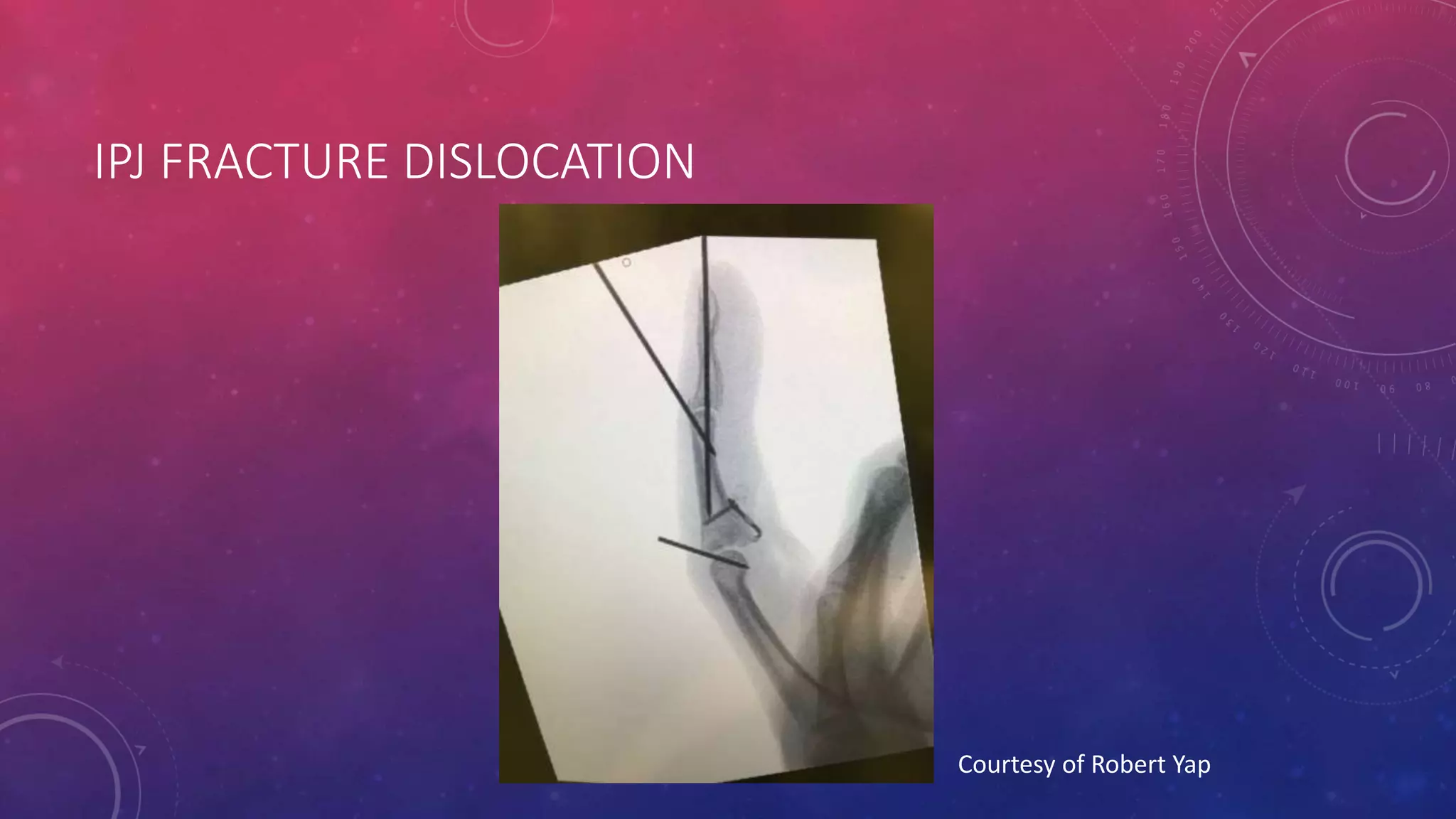 Other techniques in hand fracture treatment | PPTX