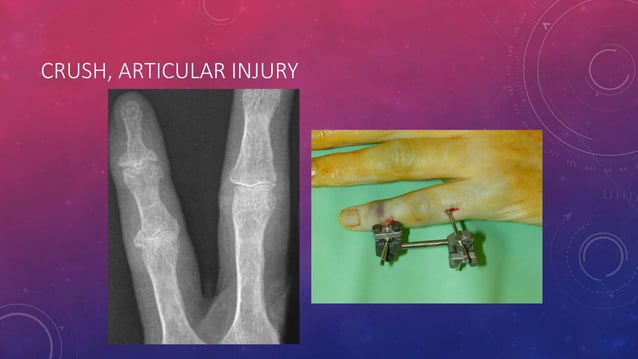 Other techniques in hand fracture treatment | PPTX