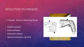 Other techniques in hand fracture treatment | PPTX