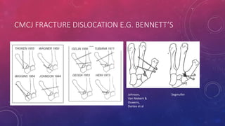 Other techniques in hand fracture treatment | PPTX