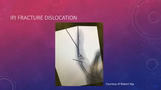 Other techniques in hand fracture treatment | PPTX