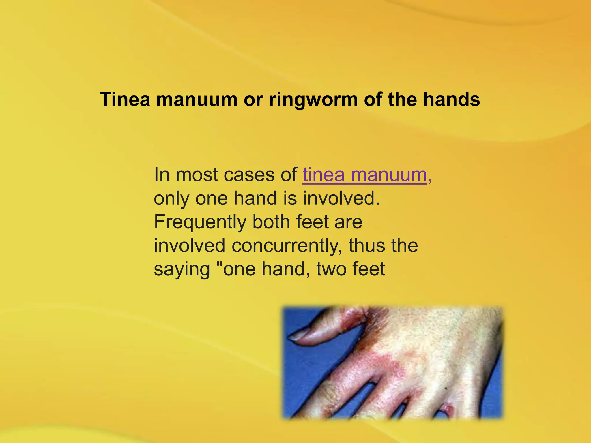other types of tineas.pdf