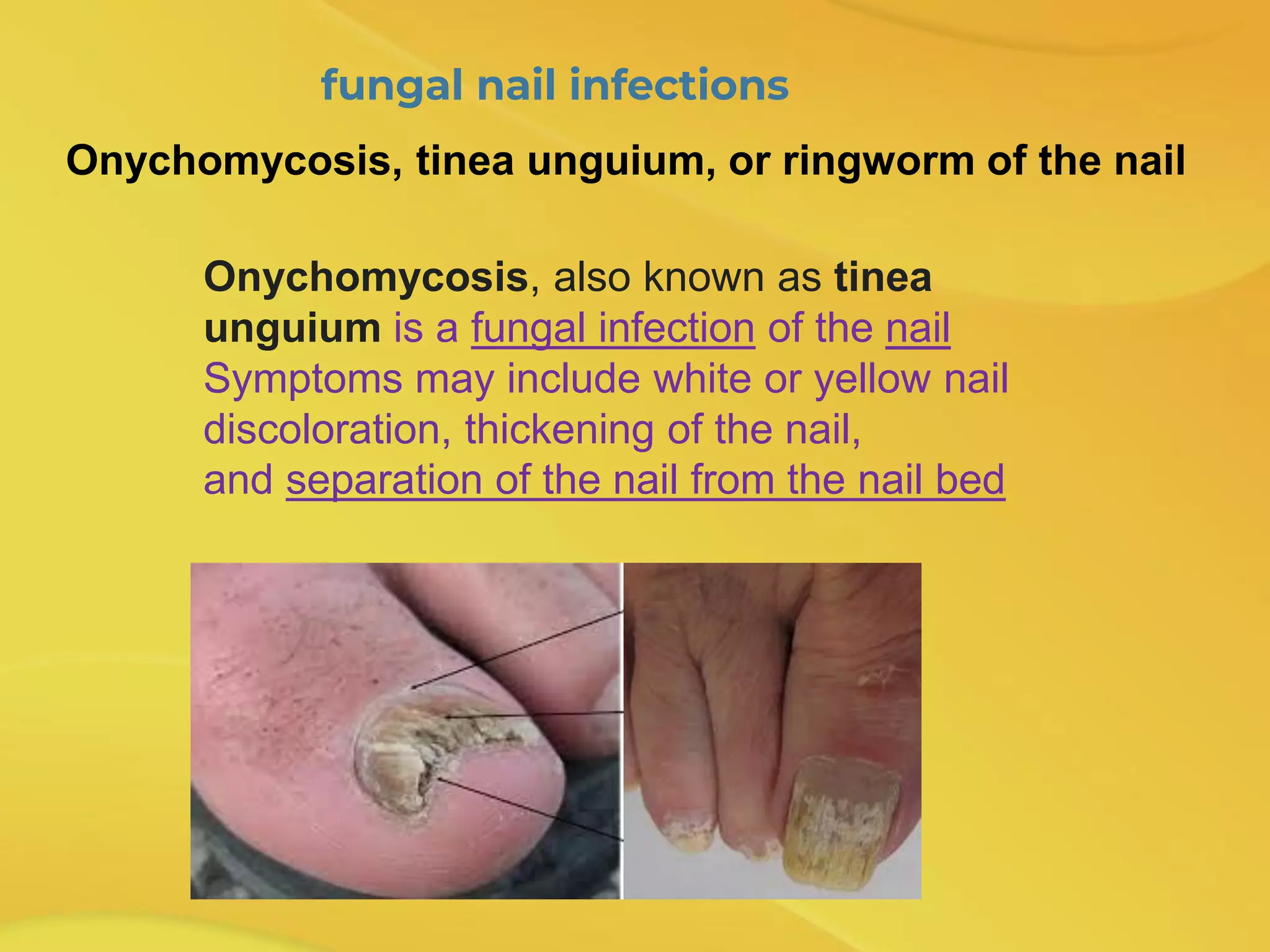 other types of tineas.pdf