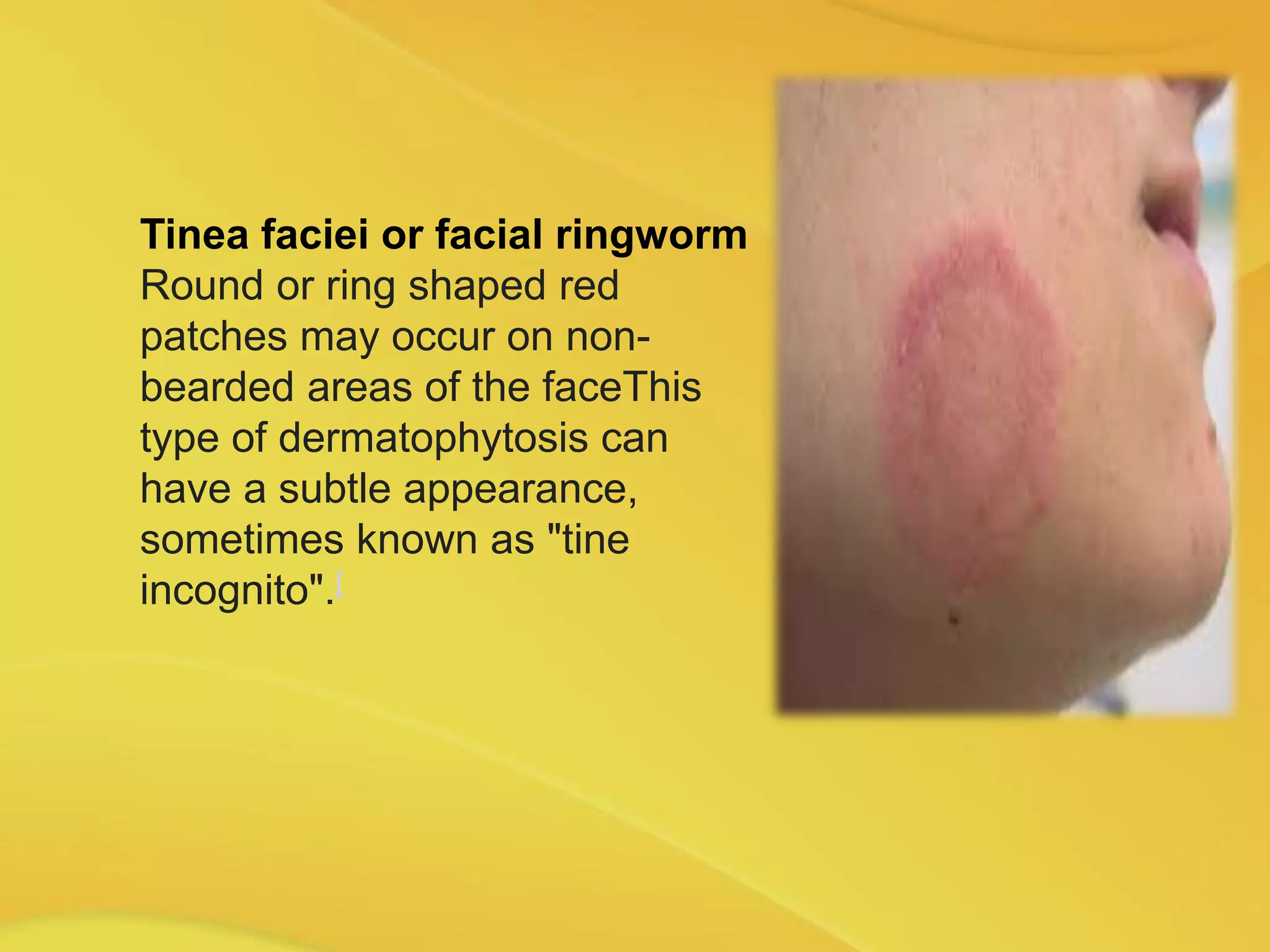 other types of tineas.pdf