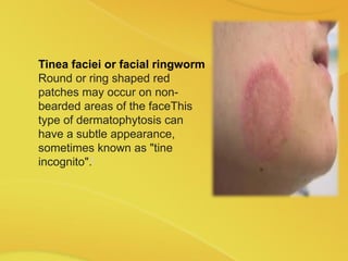 other types of tineas.pdf