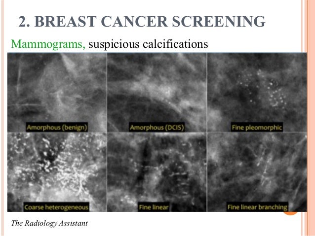 đO thị ngọc hiếu breast cancer, epidemiology and screening in vie…