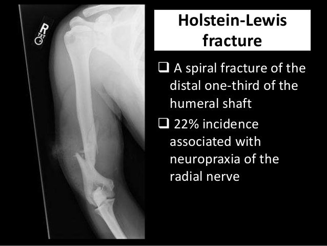 fracture shaft of humerus