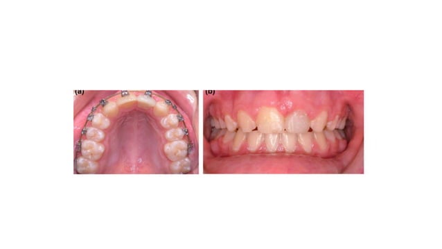 Autotransplantation research articles.pptx