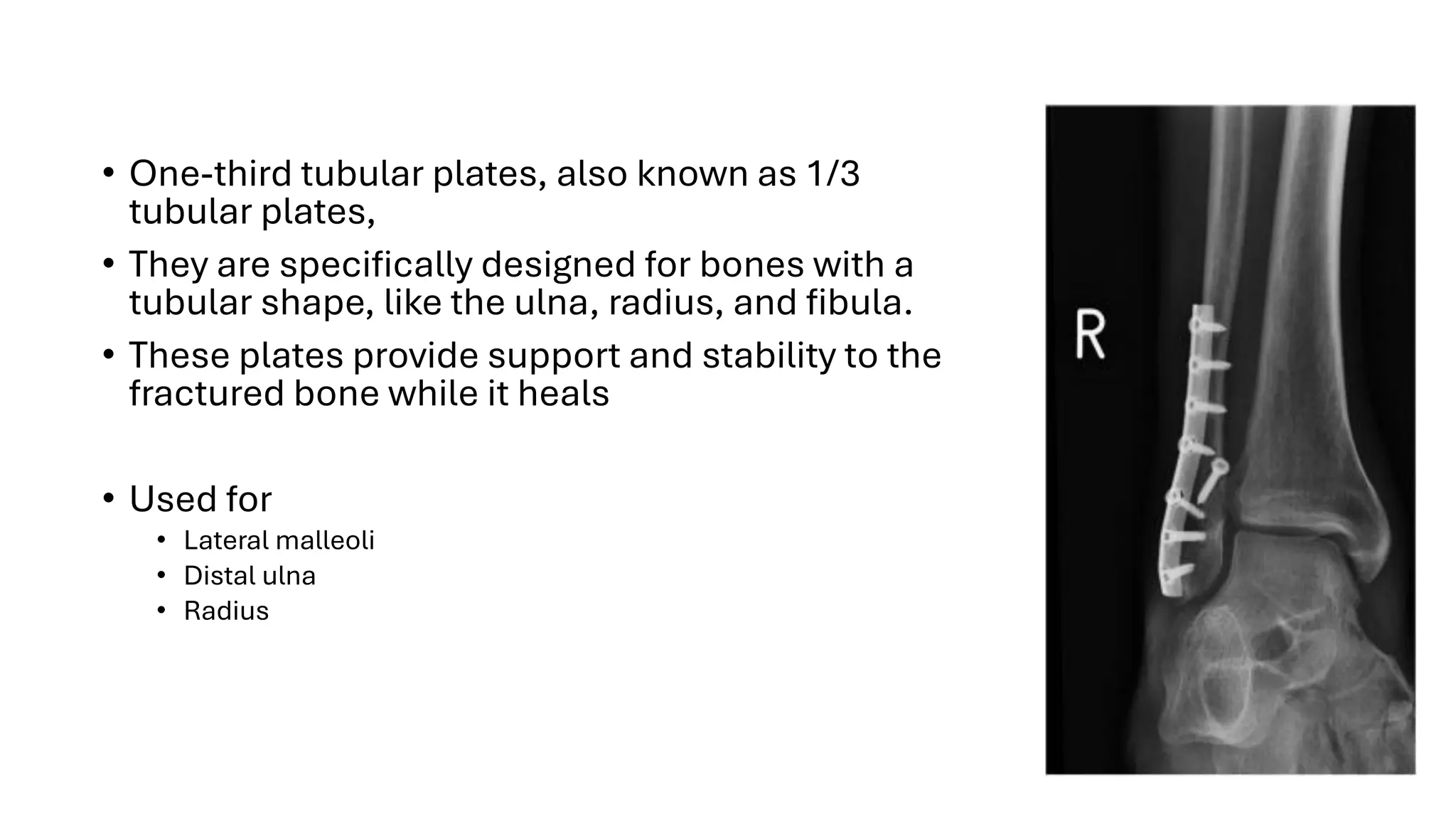 Orthopedic Implants for the surgeries of femur radius and ulna | PDF