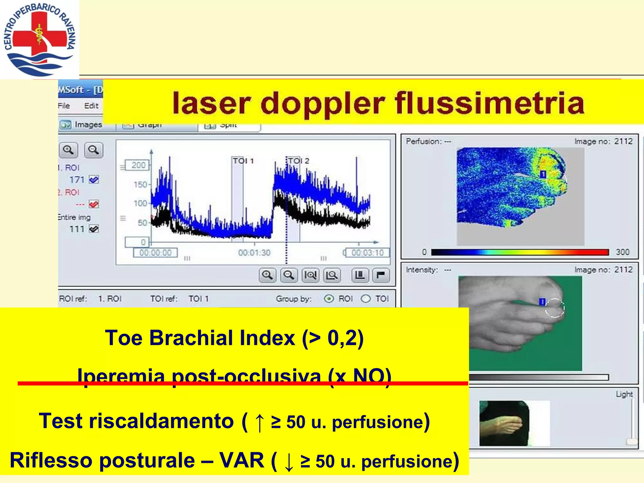 Ossigeno Terapia Iperbarica e ulcere cutanee | PPT