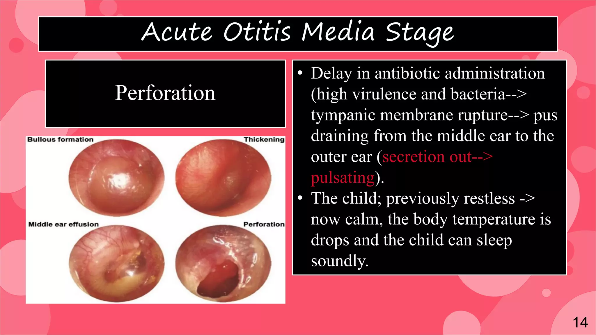 Acute Otitis Media | PDF
