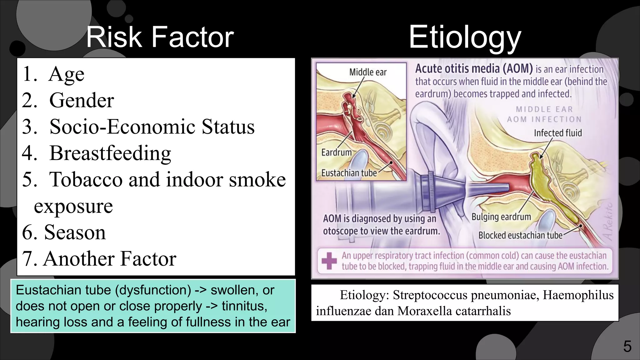 Acute Otitis Media | PDF