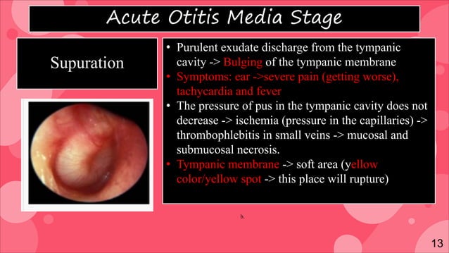 Acute Otitis Media | PDF | Ear, Nose and Throat Conditions | Diseases ...
