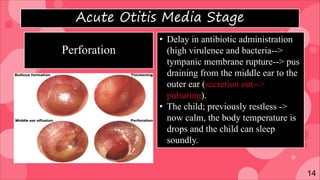 Acute Otitis Media | PDF