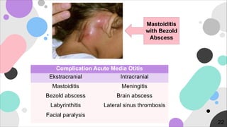 Acute Otitis Media | PDF