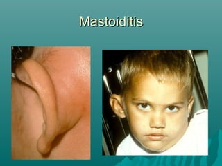 Otitis media | PPT
