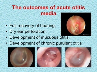 Otitis Externa And Media Ppt