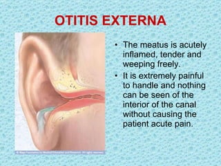 Diffuse Otitis Externa