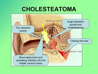 Otitis part 2 | PPT | Ear, Nose and Throat Conditions | Diseases and Conditions