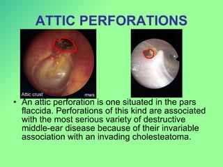 Otitis part 2 | PPT