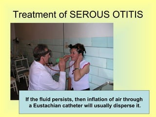 Otitis part 3 | PPT
