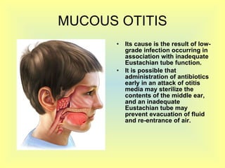 Otitis part 3 | PPT